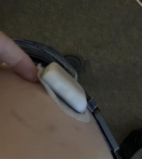 Dexcom G6 Placement Rdiabetes