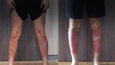 Genitals And Psoriasis How Do You Prevent From Peeling During Sex😭the Friction During Sex