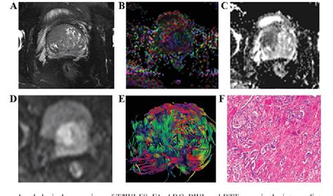 Figure 2 From Correlation Of Diffusion Tensor Imaging Parameters And Gleason Scores Of Prostate