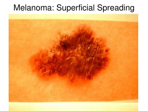 Ppt Skin Neoplasms Powerpoint Presentation Free Download Id5083646