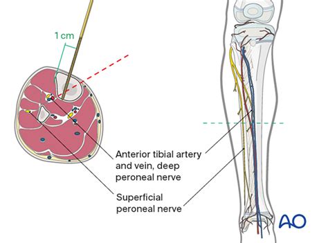All Approaches To The Pediatric Proximal Tibia