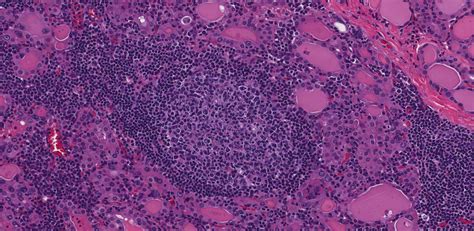 Hashimoto Thyroiditis Histology Thyroid Cancer Types Management