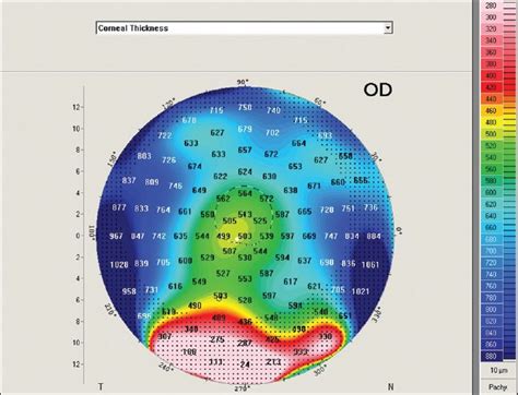 Scheimpflug Imaging For Keratoconus And Ectatic Disease Pmc