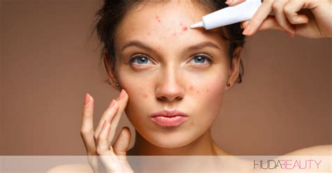 If You HAVE To Pop A Pimple This Is How You Should Do It Blog HUDA BEAUTY