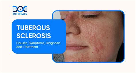 Tuberous Sclerosis Causes Symptoms Diagnosis And Treatment