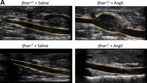 Genetic Deficiency Of Ifn α Receptor Prevents Angii Induced Aaas A