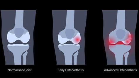 Osteoarthritis Causes Symptoms And Treatment