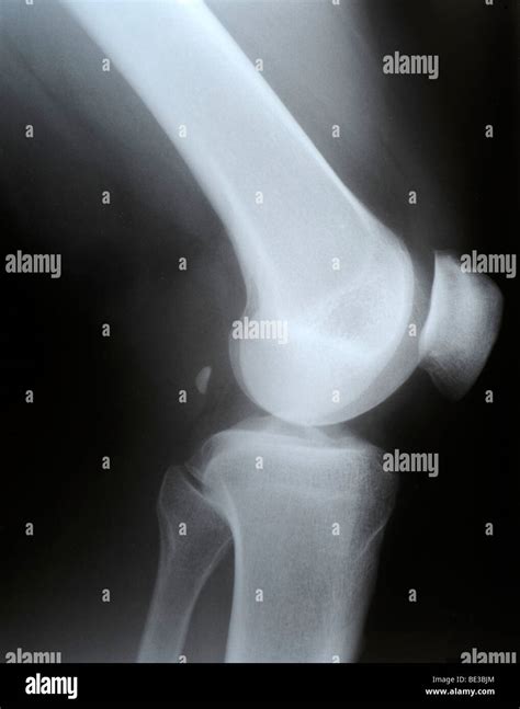 Sesamoid Bone X Ray