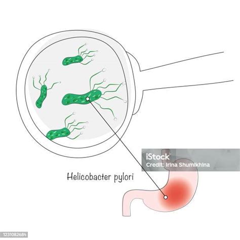 돋보기 아래 헬리코박터 박테리아 인간의 위장은 염증과 아픈 위염 궤양 가슴 앓이 트림 질병의 벡터 그림 개념에 대한 스톡 벡터