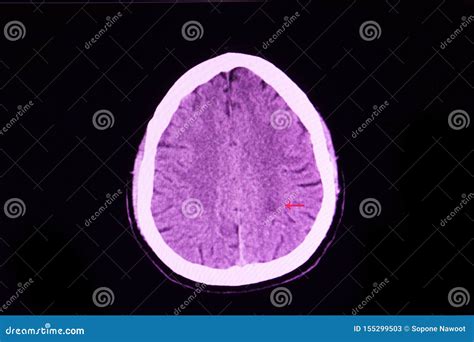 Cerebral Infarction Stock Image Image Of Hospital Background 155299503
