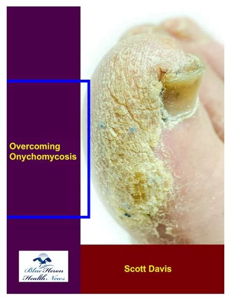 Ppt Overcoming Onychomycosis™ Ebook Pdf Download Free Powerpoint Presentation Id 11558758