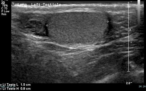 Testicular Torsion Uams Department Of Radiology