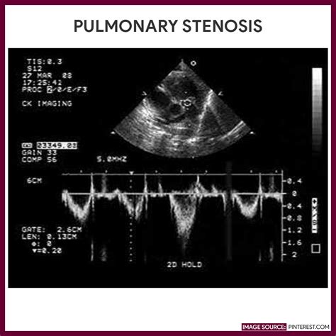 Echocardiogram Nursing Responsibilities Nurseslabs