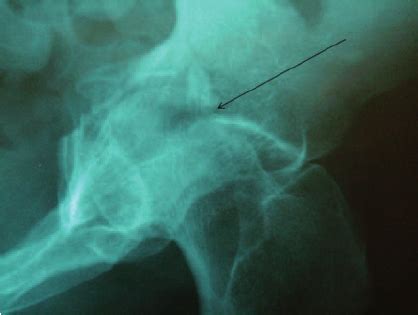 X Ray Showing An Acetabular Fracture In An Osteoporotic Patient There Download Scientific