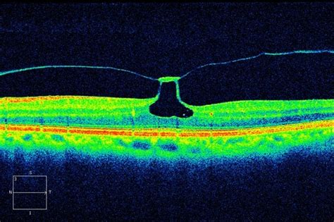 Vmt Vitreo Macular Traction Syndrome Sd Oct Retina Image Bank