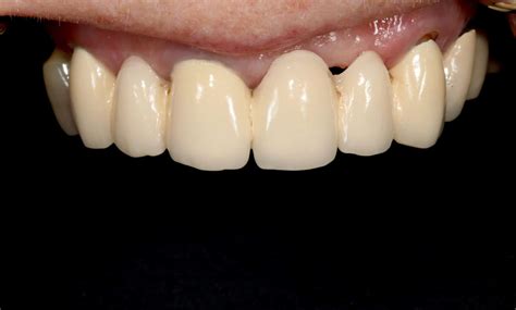 Porcelain Crowns Signature Dentistry Centennial