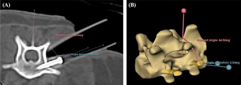 Analysis Of Screw Angle Deviation In This Specimen The Planned Screw