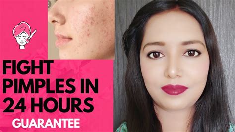 How To Remove Pimples In Hours Acne Treatment Pimples Kaise Hataye YouTube