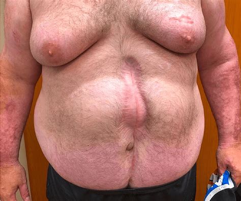 Treating Heterotopic Ossification Ho The Formation Of Ectopic Bone In