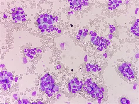 Deep Brain Stimulation And Mr Guided Focused Ultrasound In Parkinsons Disease Medizinonline