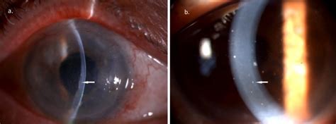 Cmv Endotheliitis A Cause For Recurrent Failed Corneal Transplant Pmc
