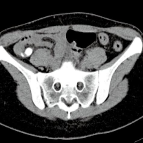Pelvic Ct With Two Calcified Masses In Enlarged Noninflammed Appendix