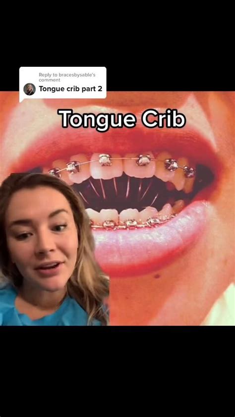 Tongue Crib These Are Not Used That Often Braces Bracesoff