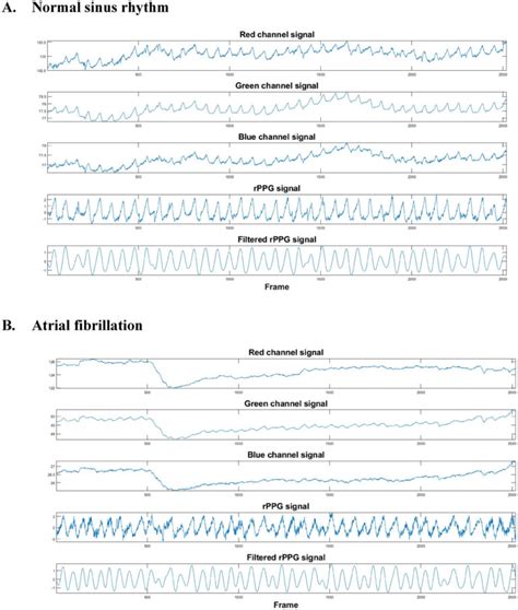 Remote Photoplethysmography Rppg Development Best Digital Transformation Company In India