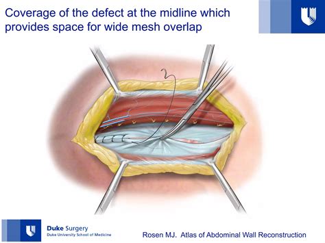 Abdominal Wall Anatomy With Respect To Understanding Component Separation Pdf