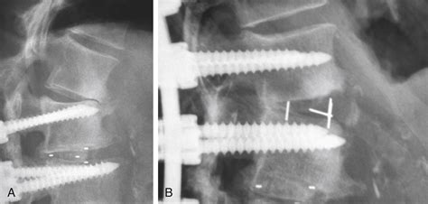 An Approach For Treatment Of Complex Adult Spinal Deformity Clinical Tree