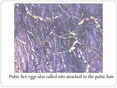 Ppt Pubic Lice Whats Living In Youre Genitals Powerpoint