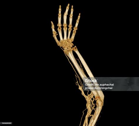 Ct 스캐너에서 상지 뼈 3d 렌더링이 있는 팔의 상완 동맥 팔 신체 부분에 대한 스톡 사진 및 기타 이미지 팔 신체 부분 3차원 형태 손 Istock