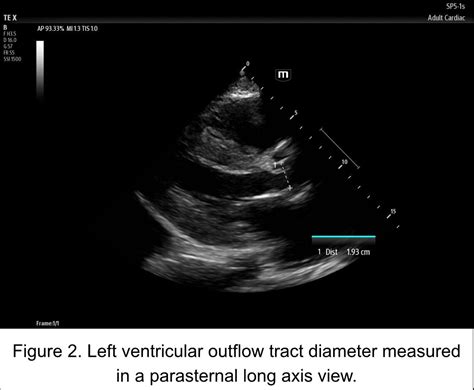 Us Probe Velocity Time Integral Vti In Sepsis Management Emdocs