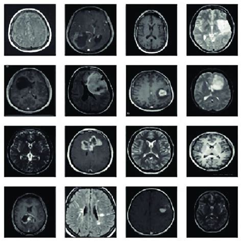 Brain Tumor Magnetic Resonance Imaging Mri Image Download Scientific Diagram