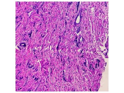 기저 세포 암종의 현미경보기는 피부암의 일종입니다 프리미엄 사진
