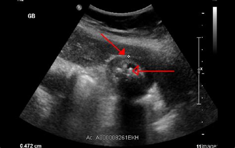 Diagnosing Acute Cholecystitis Radiology Report