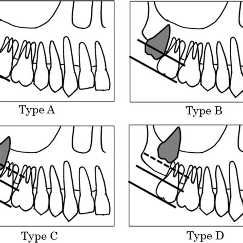 Archer Third Molar Classification [8] 1 Mesioangular 2 Download Scientific Diagram