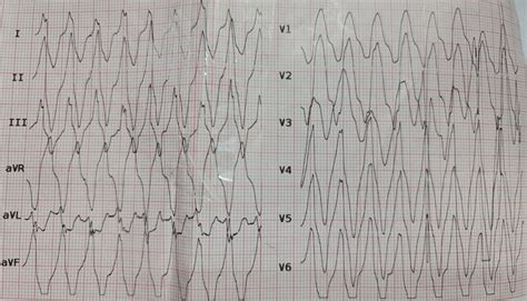 Ventricular Tachycardia Caused By Hyperkalemia Download Scientific Diagram