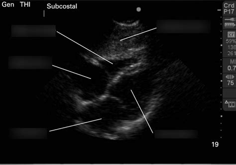 Subcostal View Us Diagram Quizlet