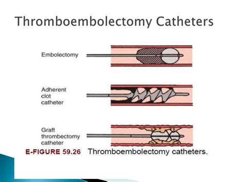 Arterial And Venous Embolectomy Pptx