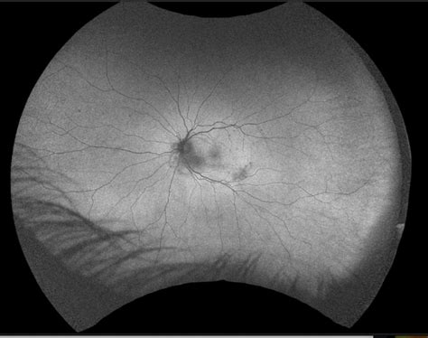 What Are Floaters What Are Floaters