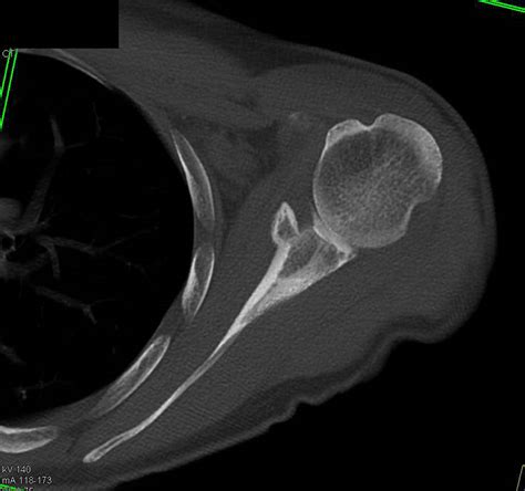 Scapula Fracture Types Radiology At Darla Adkins Blog