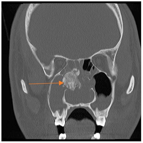 Osteosarcoma Jaw X Ray