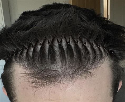 4 Month Update Transplant And Finasteride R Tressless