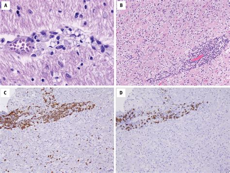 Demyelinating Disorders Clinical Tree