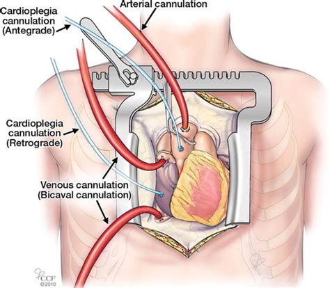 Cardiopulmonary Bypass Cardiopulmonary Bypass