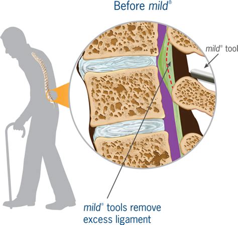 Download Before Mild Spinal Stenosis Mild Procedure Clipartkey
