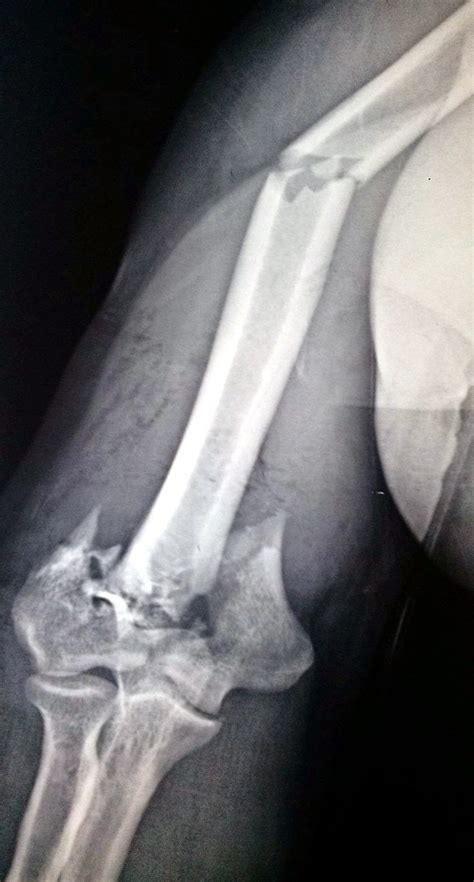 O R T O C R I T I C A Fractura Segmentaria De Humero