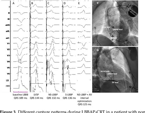 Figure 1 From Conduction System Pacing For Cardiac Resynchronization Therapy Semantic Scholar
