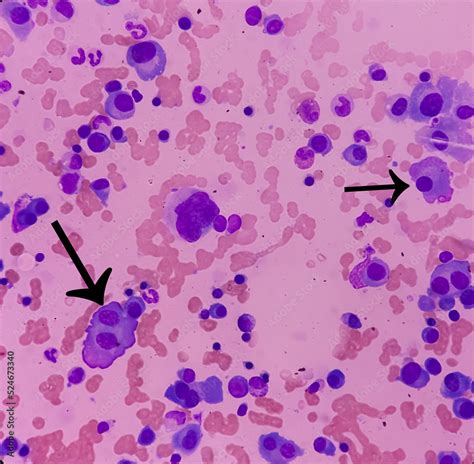Microscopic Image Of Bone Marrow Plasma Cell Dyscrasia Or Multiple